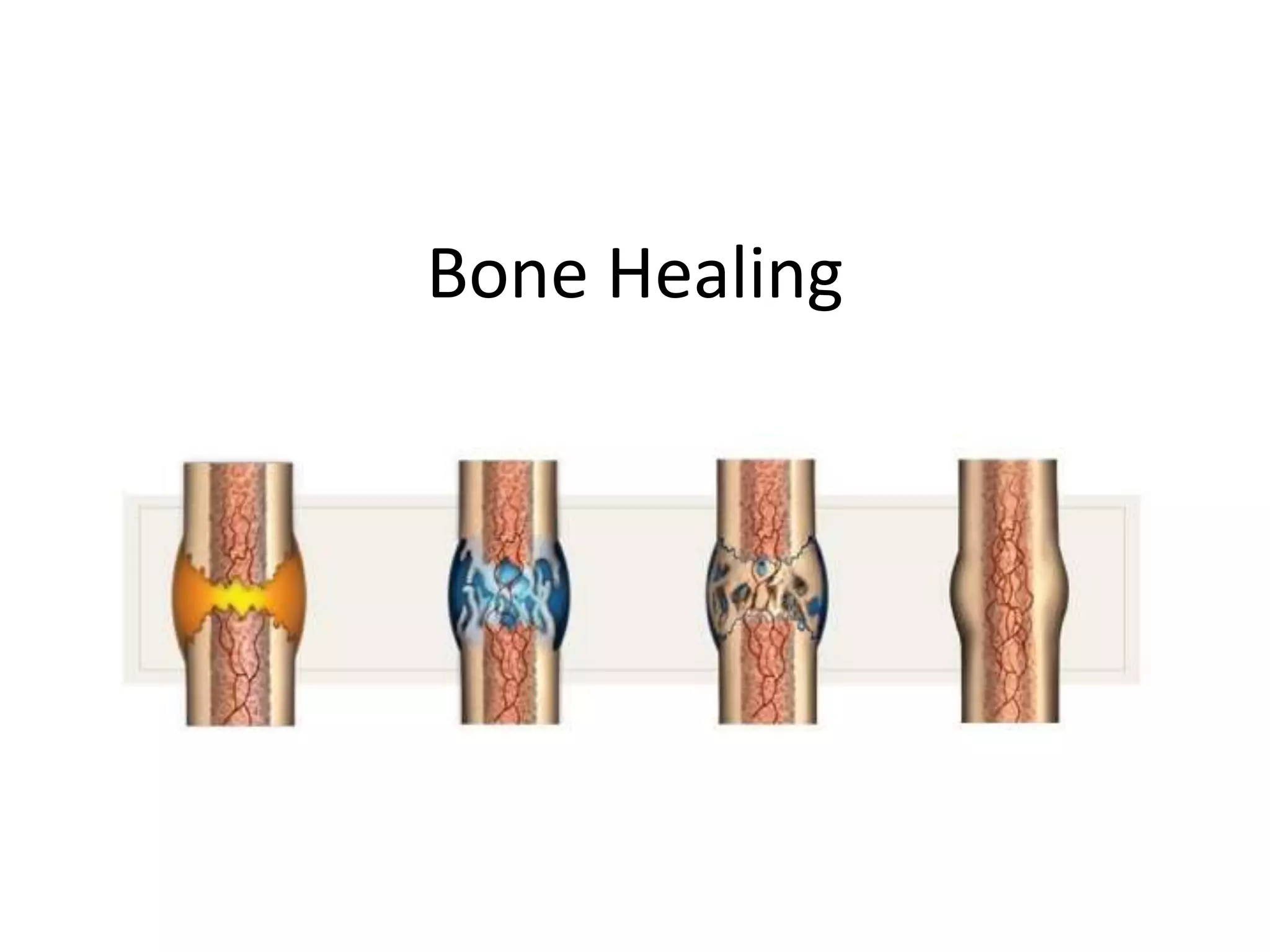 Bone healing | PPTX