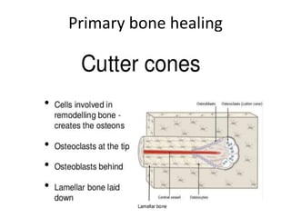 Bone healing | PPTX