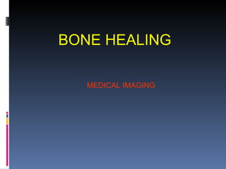 Bone Healing PATHOLOGY.ppt in radiography | PPT