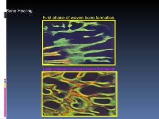 Bone Healing PATHOLOGY.ppt in radiography | PPT
