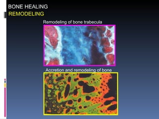 Bone Healing PATHOLOGY.ppt in radiography | PPT