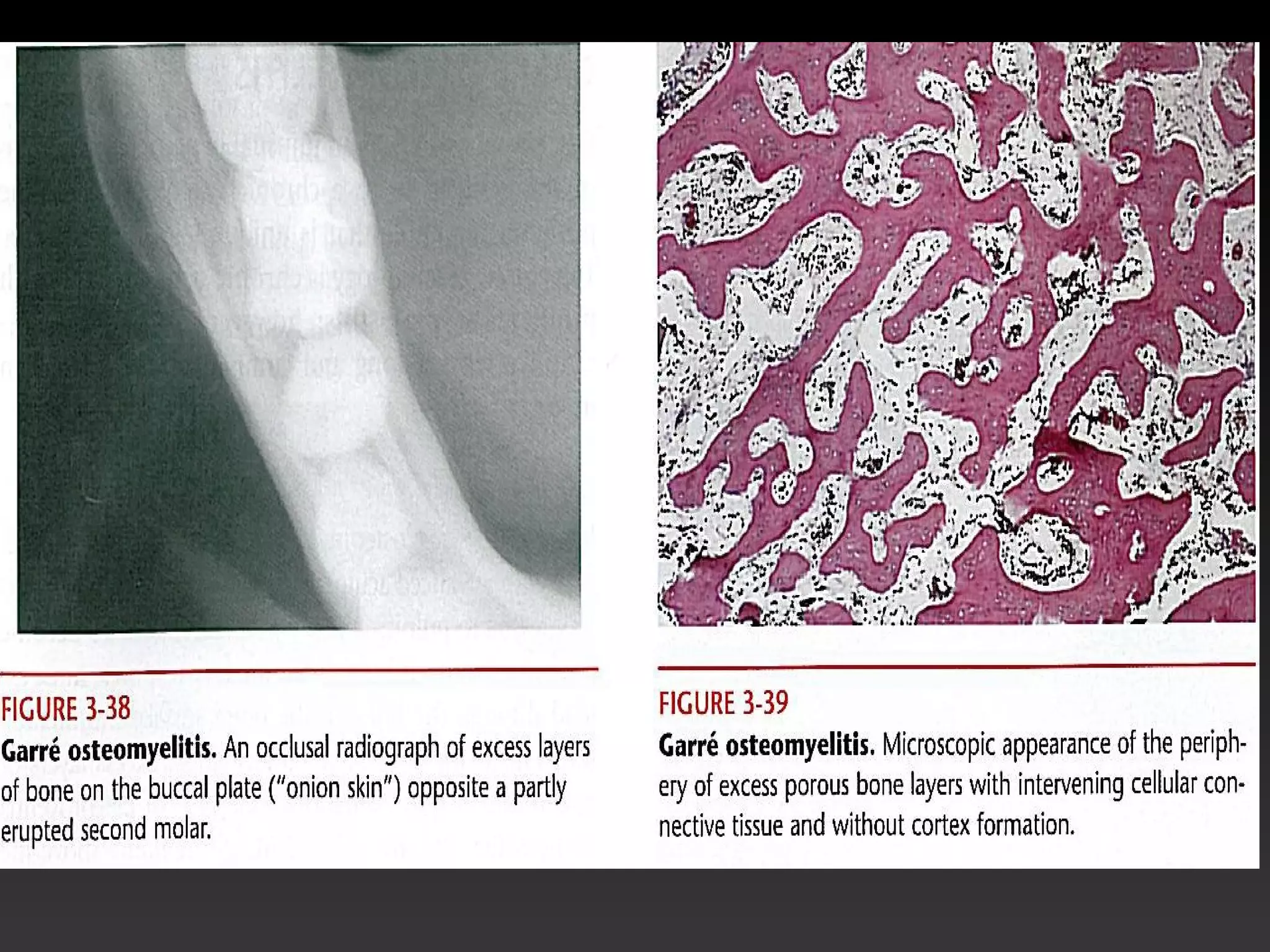 Bone infection dina patho | PPT