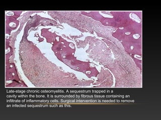 Bone infection dina patho | PPT