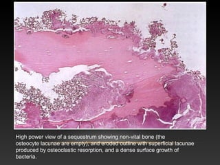 Bone infection dina patho | PPT