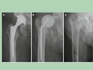 Bone infection | PPT