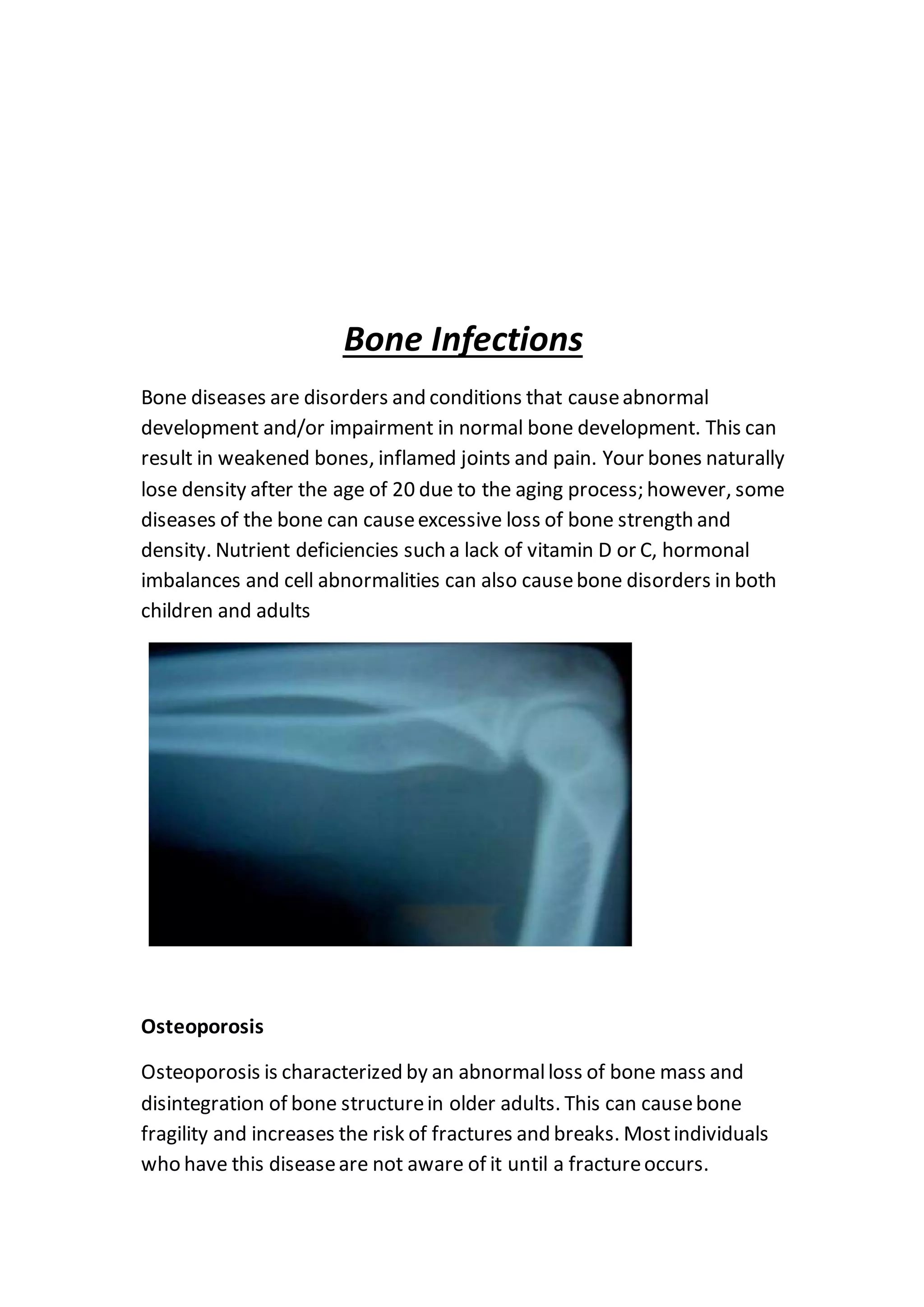 Bone infections | DOCX