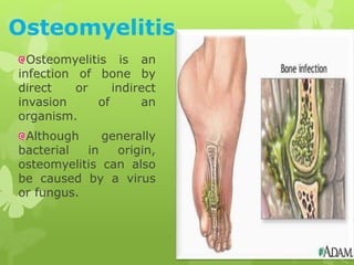 Bone infections | PPTX