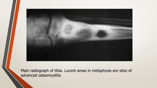 Bone infections...5 th stage lecture(dr.farouk)