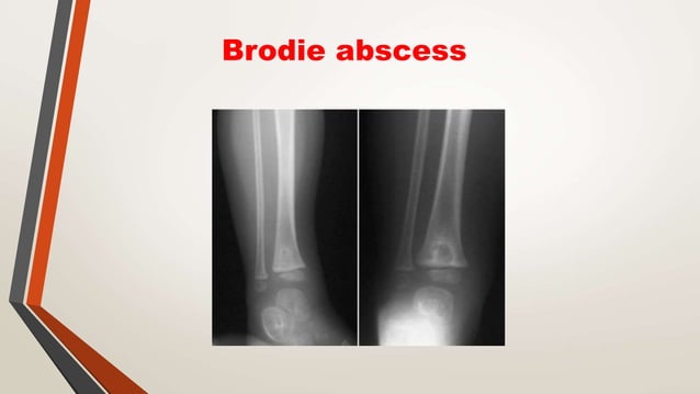 Bone infections...5 th stage lecture(dr.farouk)