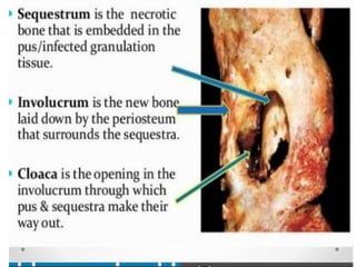 BONE INFECTIONS.pptx