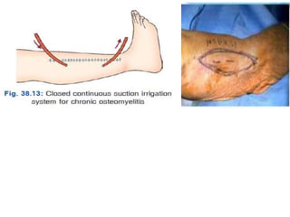 BONE INFECTIONS.pptx