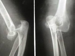 Bone injuries | PDF