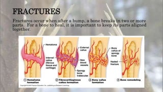 Bone injuries | PPT