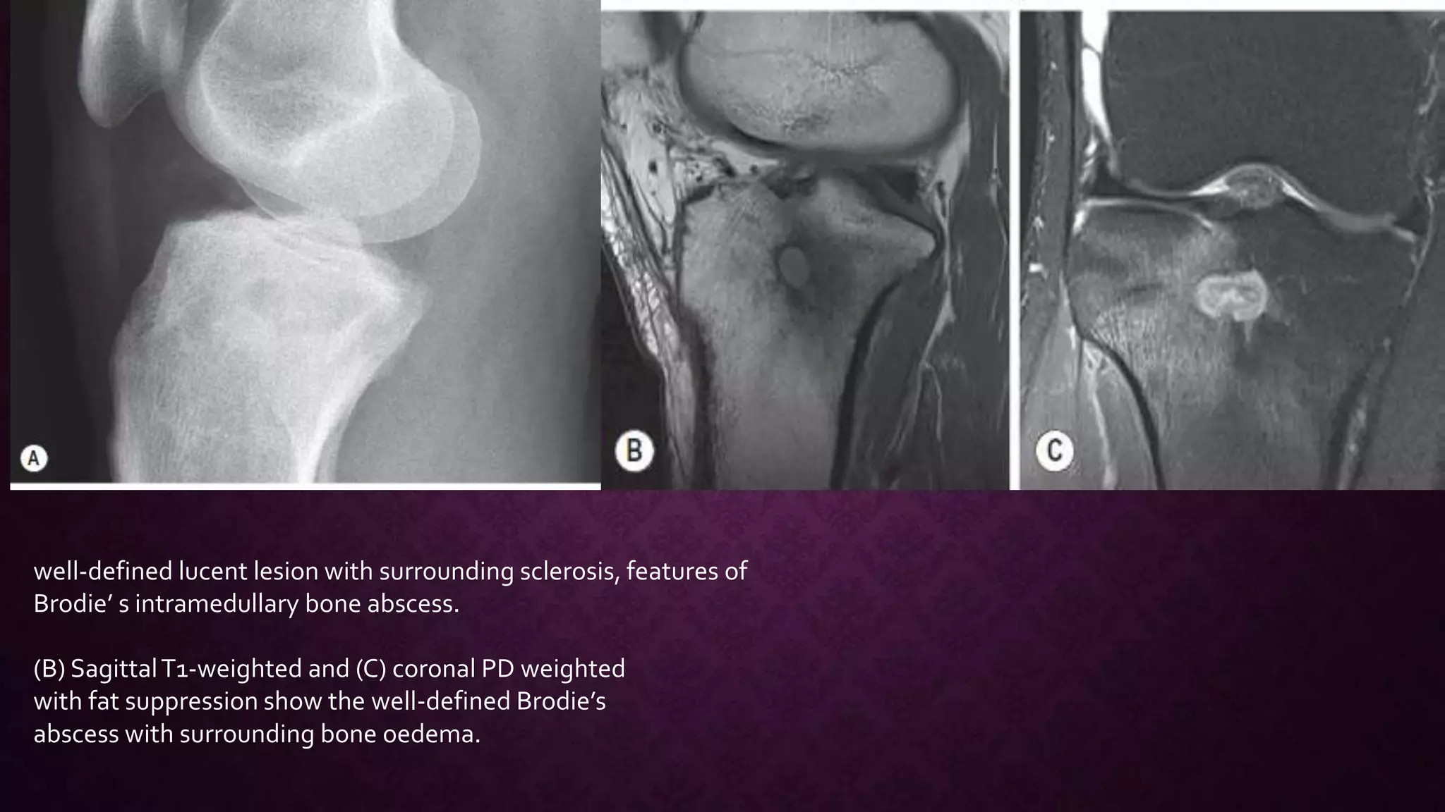 Bone, joint and spinal infection | PPTX