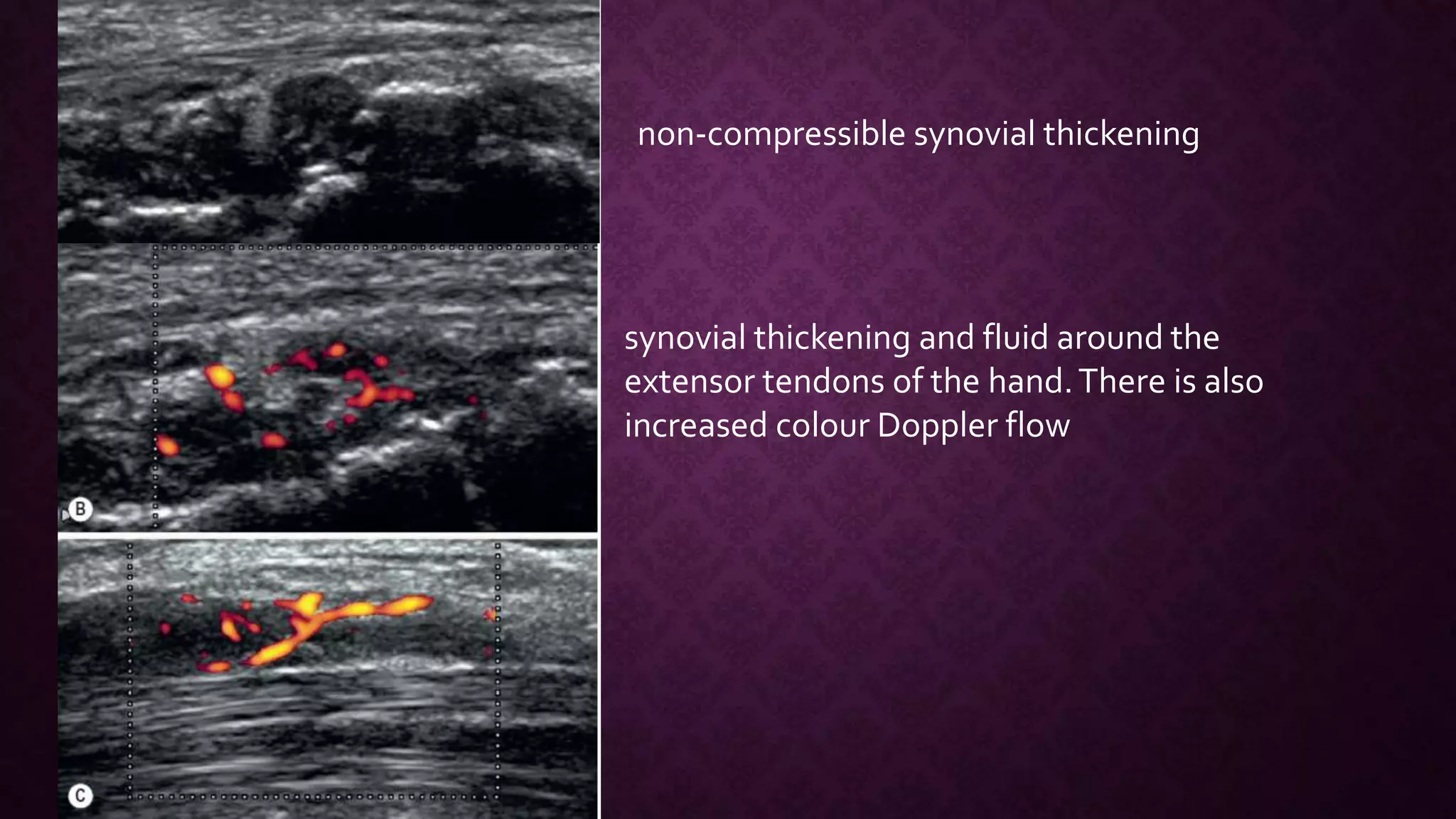 Bone, joint and spinal infection | PPTX