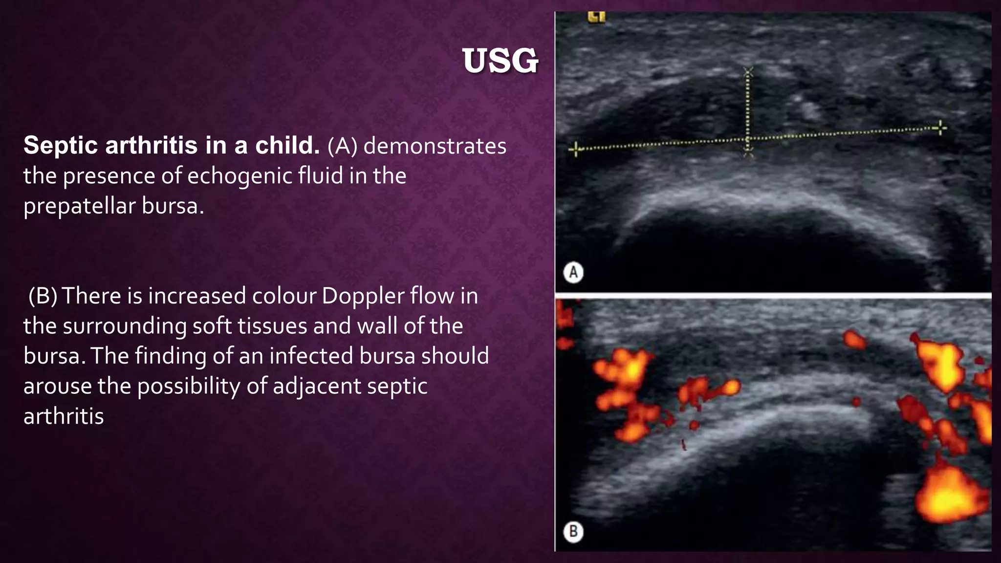 Bone, joint and spinal infection | PPTX