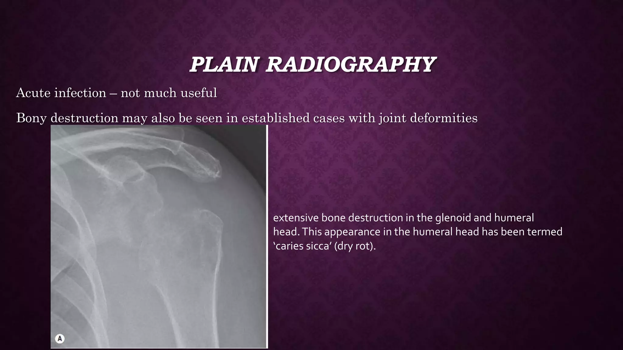 Bone, joint and spinal infection | PPTX