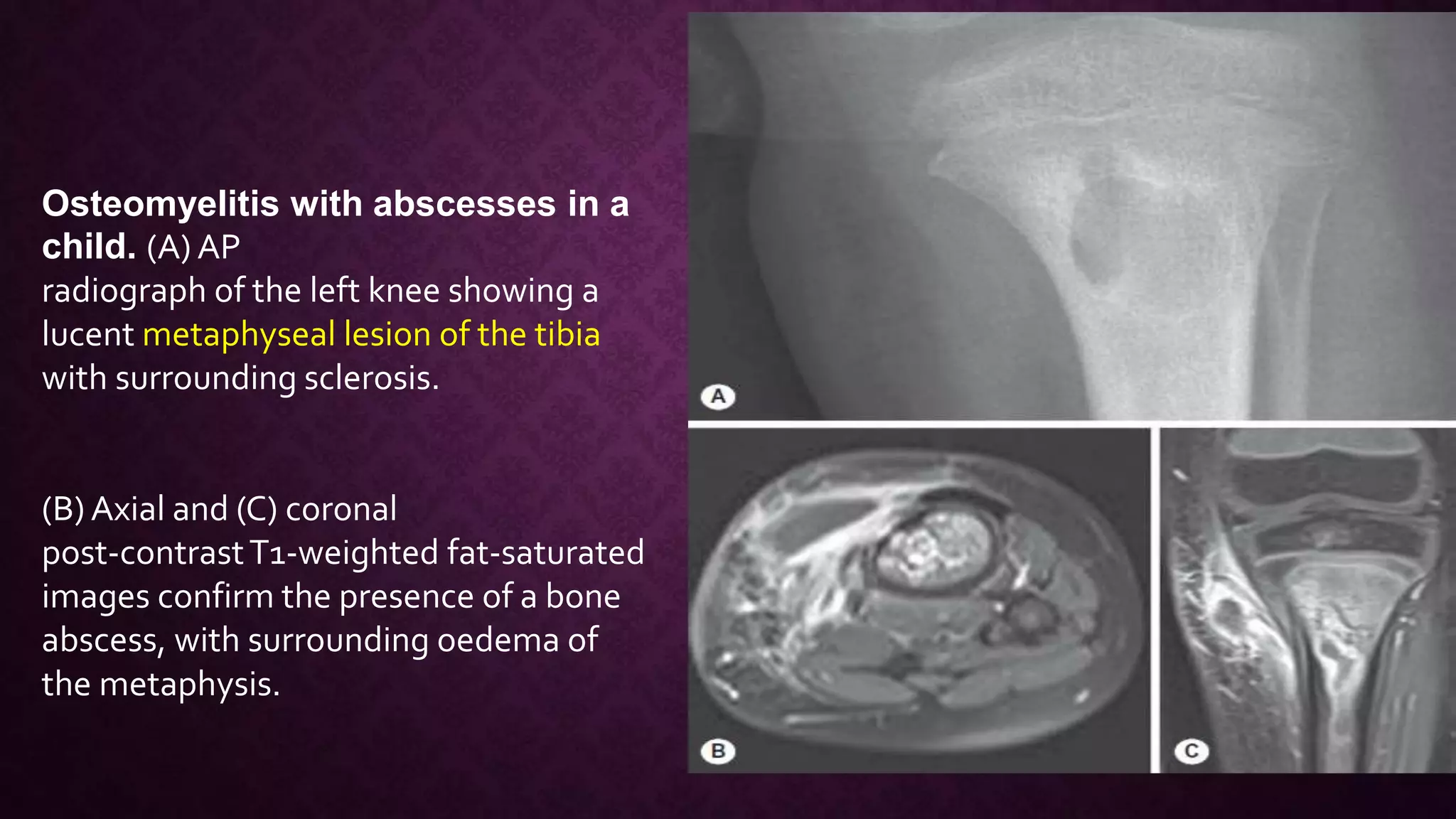 Bone, joint and spinal infection | PPTX