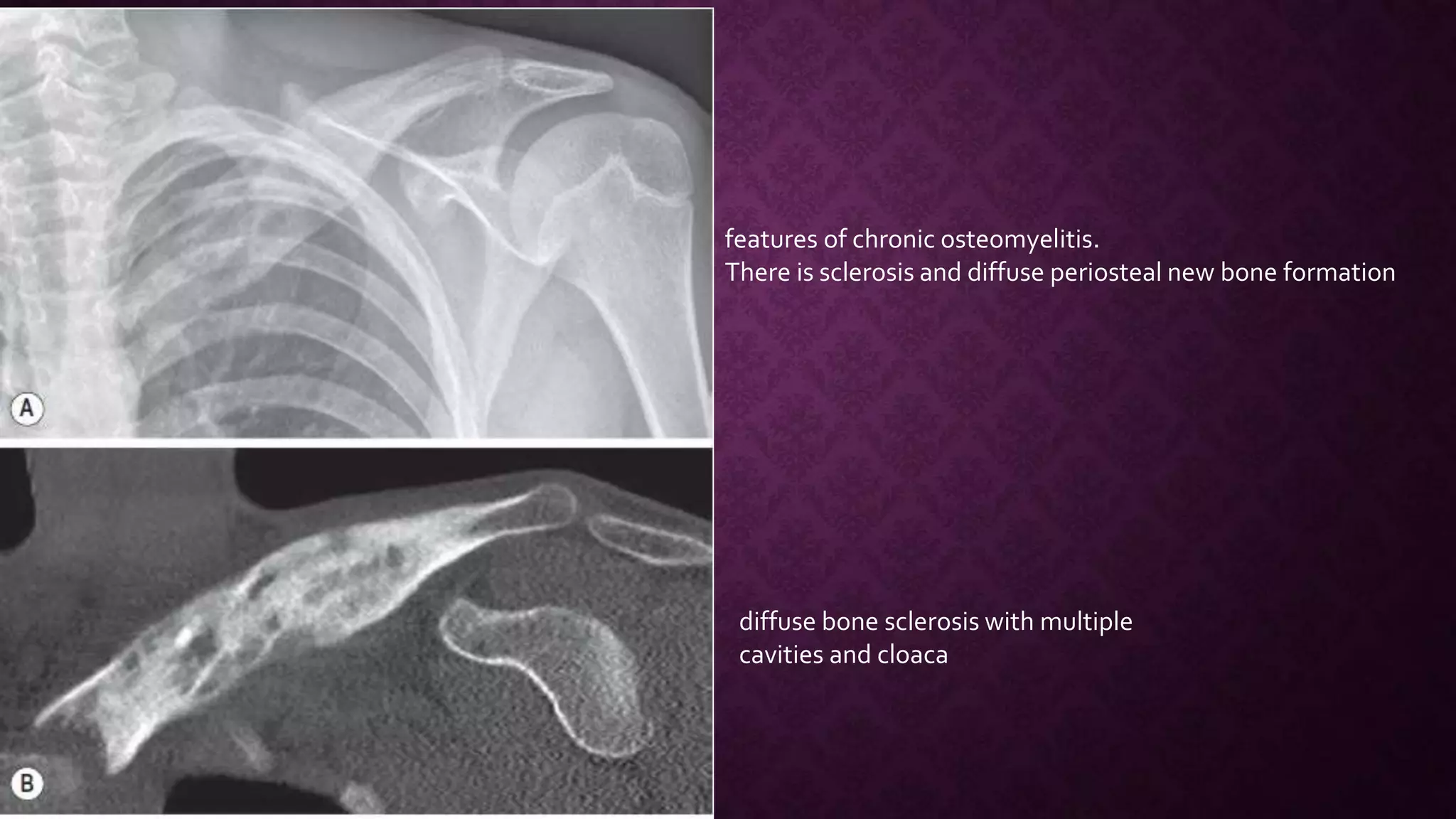 Bone, joint and spinal infection | PPTX