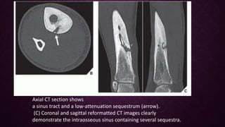 Bone, joint and spinal infection | PPTX
