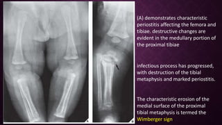 Bone, joint and spinal infection | PPTX