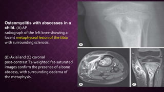 Bone, joint and spinal infection | PPTX