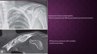 Bone, joint and spinal infection | PPTX