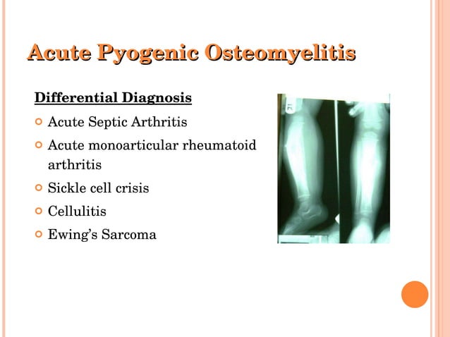 Bone+joint infections | PPT | Bone and Joint Conditions | Diseases and ...