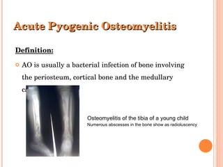 Bone+joint infections | PPT