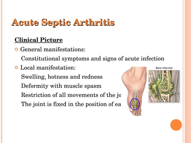 Bone+joint infections | PPT | Bone and Joint Conditions | Diseases and Conditions