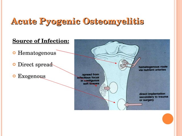 Bone+joint infections | PPT | Bone and Joint Conditions | Diseases and Conditions