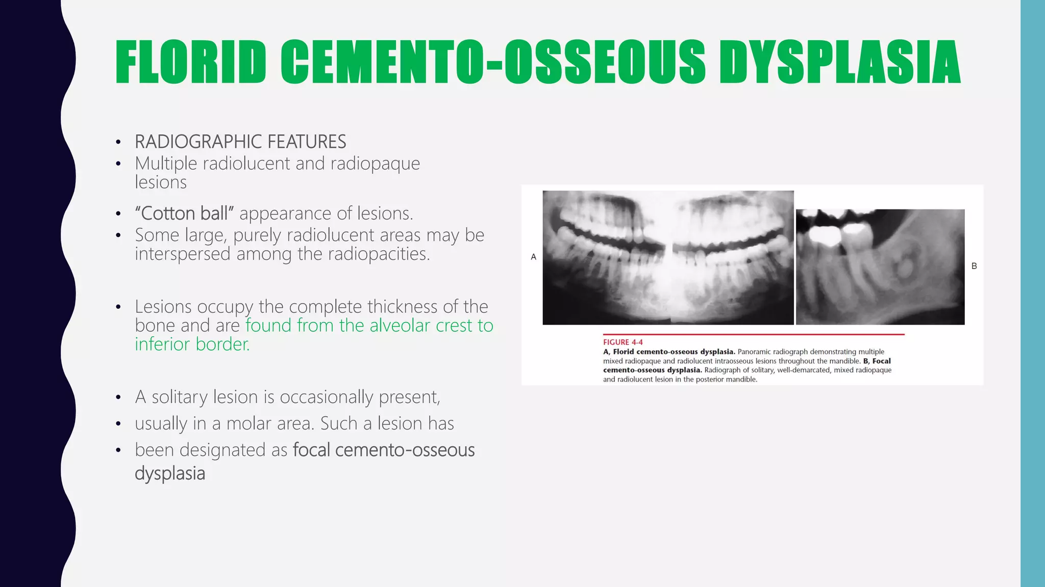 Bone Lesions Oral Pathology | PPTX