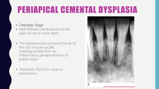 Bone Lesions Oral Pathology | PPT