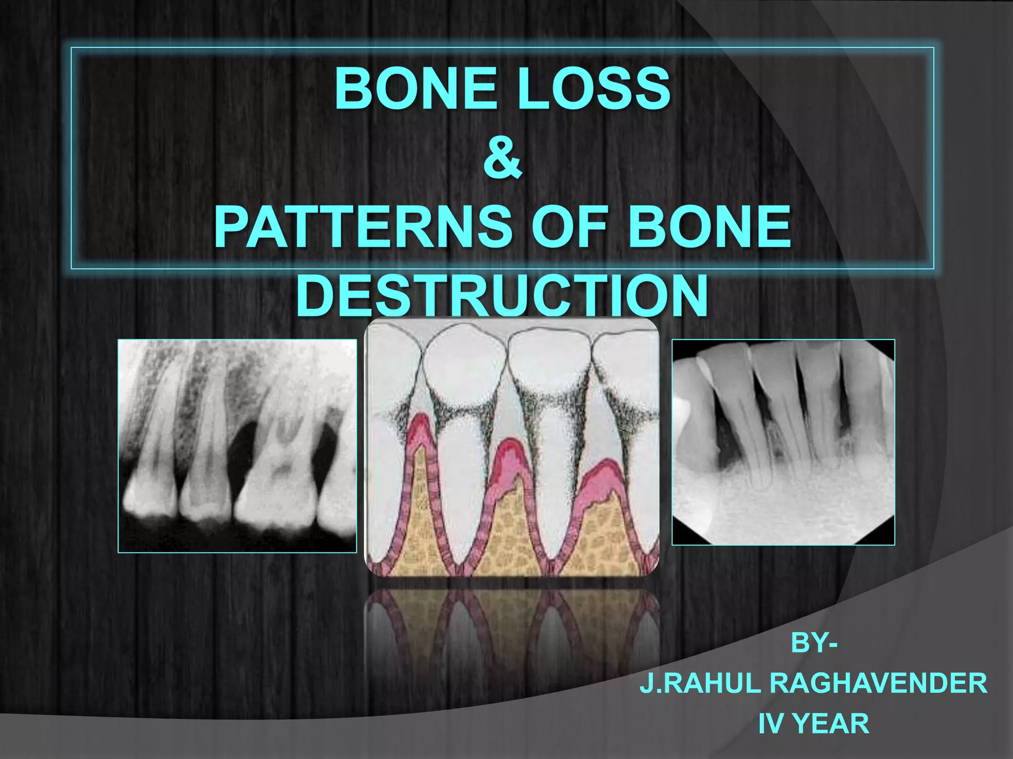 Bone loss and patterns of bone destruction | PPT