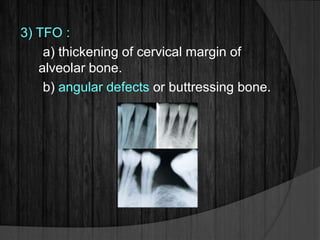 Bone loss and patterns of bone destruction | PPTX