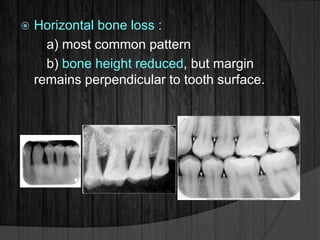 Bone loss and patterns of bone destruction | PPTX
