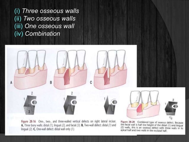 Bone loss and patterns of bone destruction | PPTX
