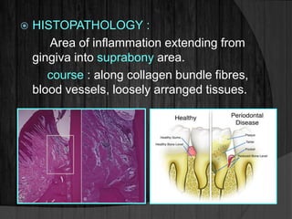 Bone loss and patterns of bone destruction | PPTX