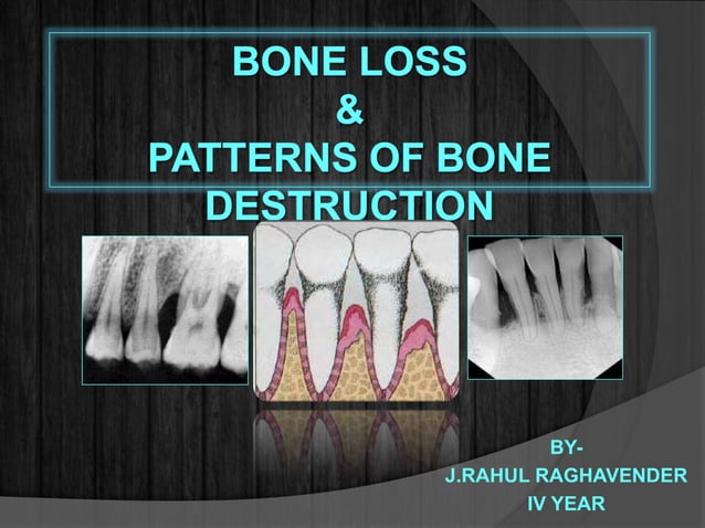 Bone loss and patterns of bone destruction | PPT