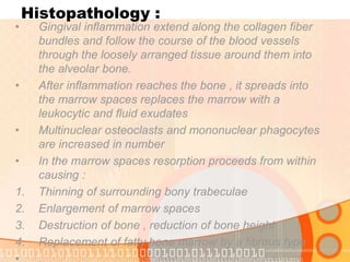 BONE LOSS.ppt