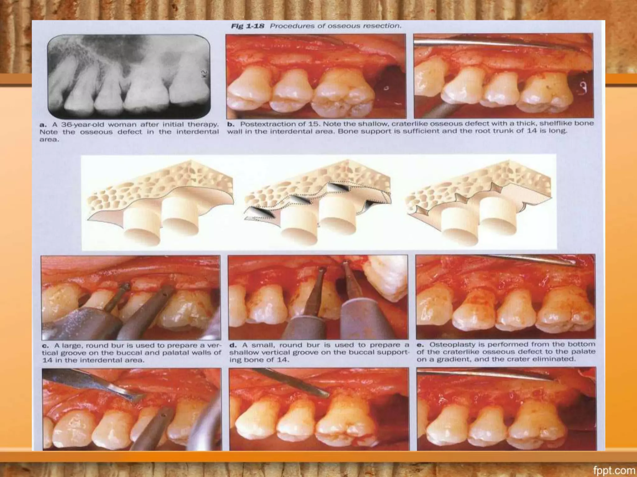 Bone loss and pattern of destruction | PPTX