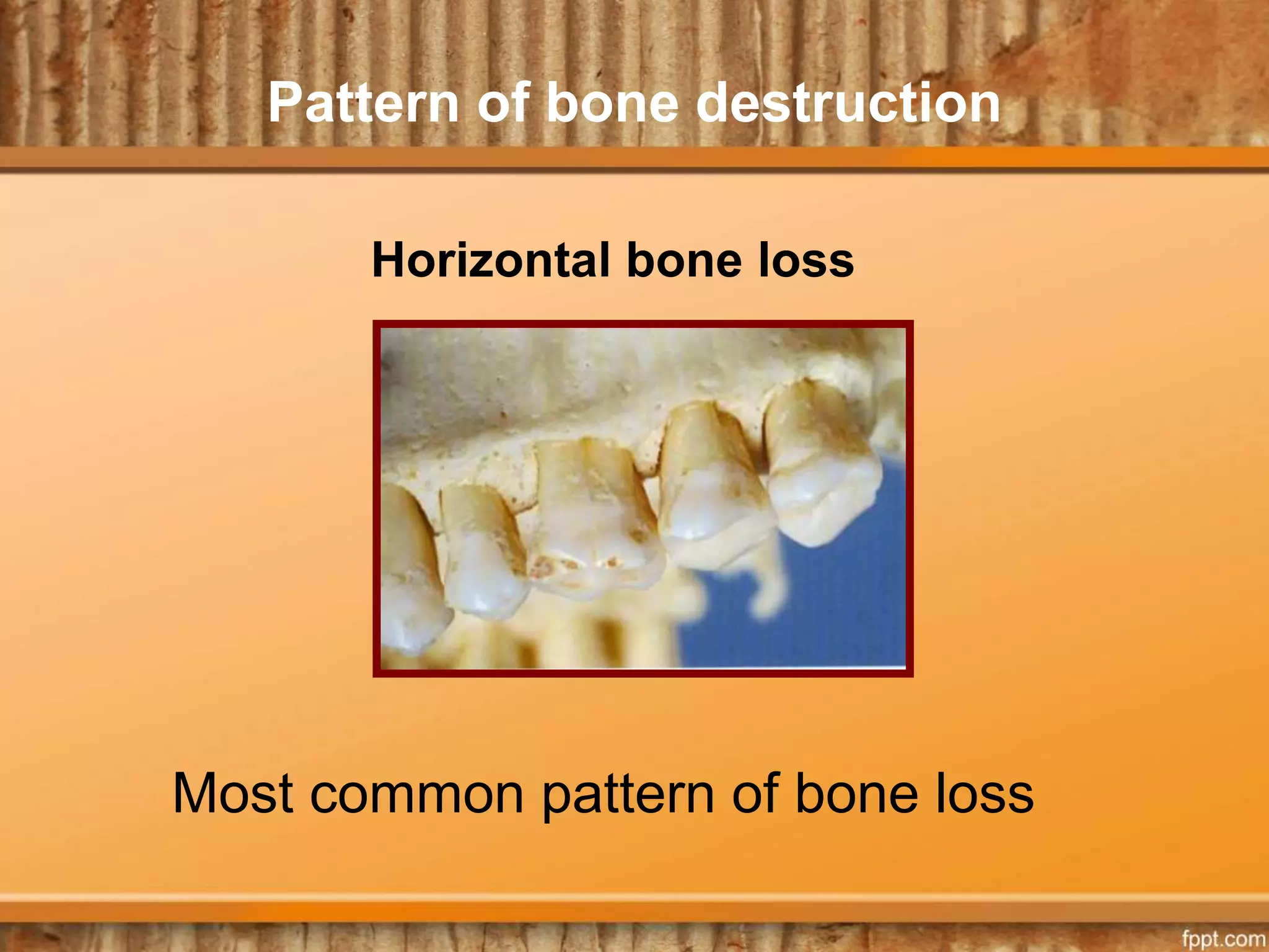 Bone loss and pattern of destruction | PPTX