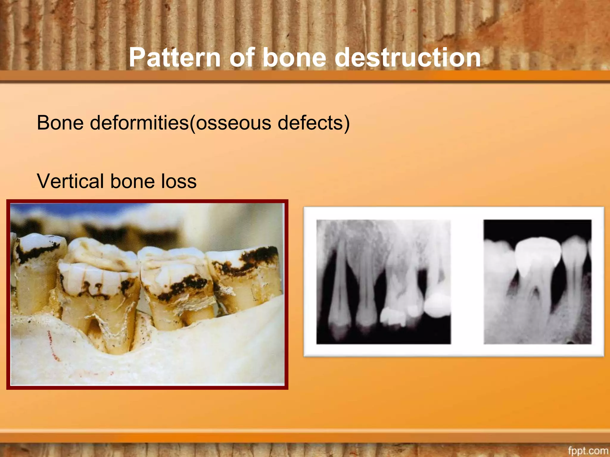 Bone loss and pattern of destruction | PPTX