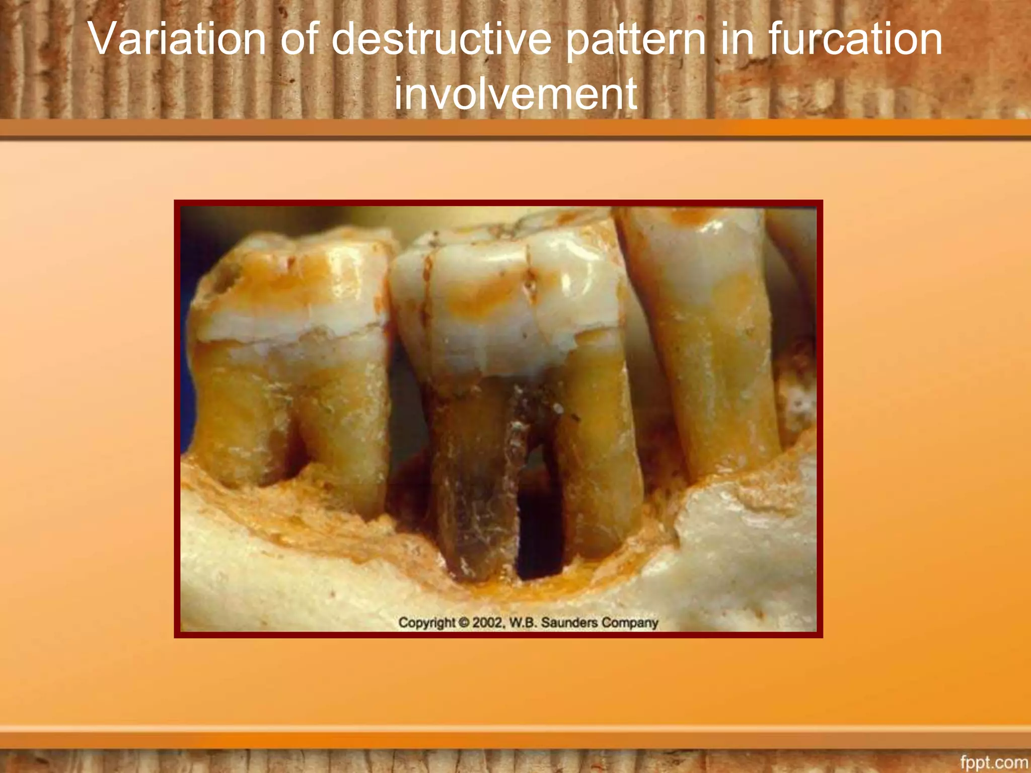 Bone loss and pattern of destruction | PPTX