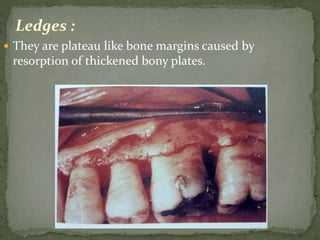 Bone loss and patterns of bone destruction | PPTX