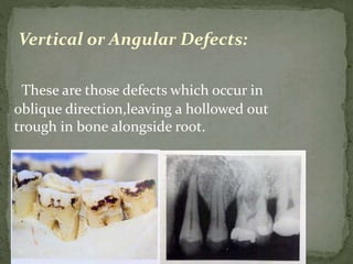 Bone loss and patterns of bone destruction | PPT