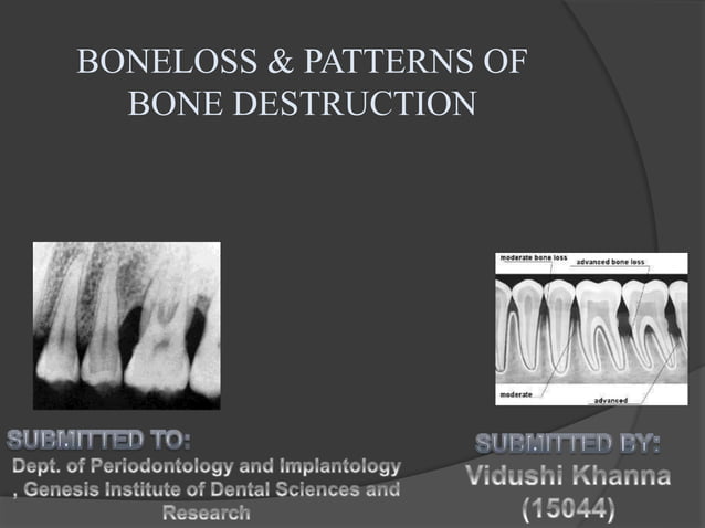 boneloss and patterns of bone destruction-190216140747.pptx