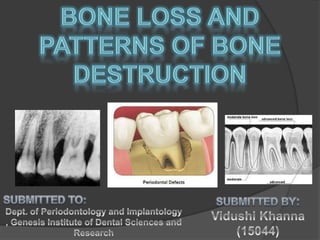 Bone loss and patterns of bone destruction | PPTX