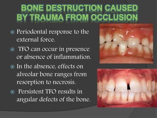 Bone loss and patterns of bone destruction | PPTX