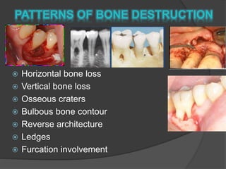 Bone loss and patterns of bone destruction | PPTX